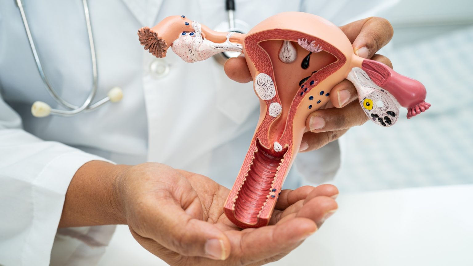 ¿Qué es el síndrome de ovario poliquístico? - Clinica Andes Salud Puerto Montt